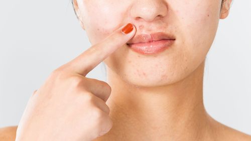 Foods That Cause Pimples: 10 Snacks To Avoid | Zee Zest